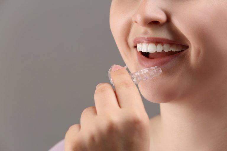 Can Invisalign Fix Overbite? Here’s What You Need To Know | Dentist in ...