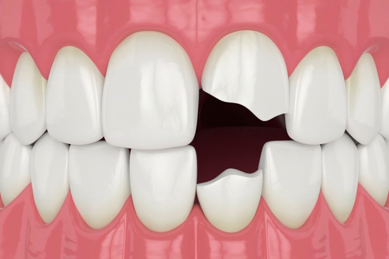 Dental Bonding in Mandeville, LA, For Chipped Teeth